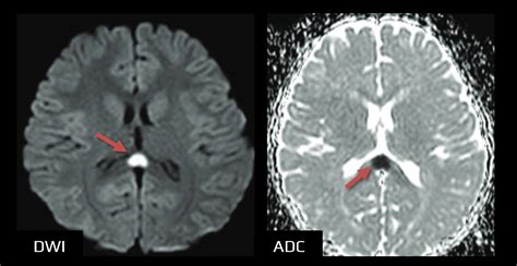 Lesions Of The Corpus Callosum Stroke Manual