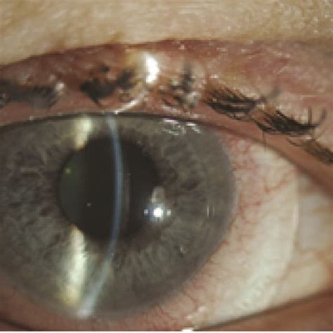 Pdf Ocular Graft Versus Host Disease Following Allogeneic Stem Cell Transplantation A Review
