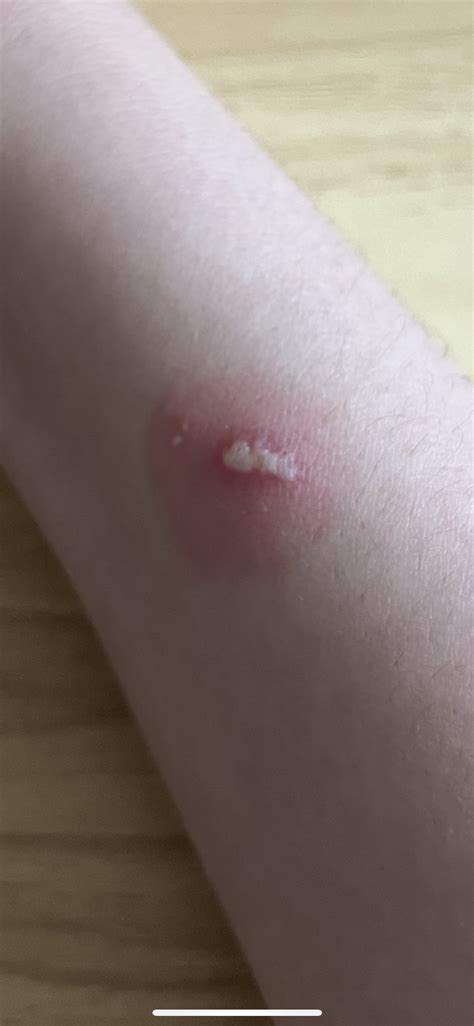 손목 염증 지식in