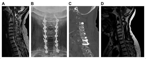 Preoperative Sagittal Magnetic Resonance Imaging Mri Demonstrating