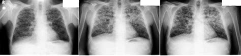 Chest Radiographs Of The Patient From Left To Right On Admission One Download Scientific