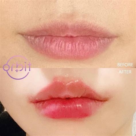 오빗클리닉 ️오빗은 전후사진 보정을 하지 않습니다 ️내돈내산 후기☺️💋💖 필러맛집💋