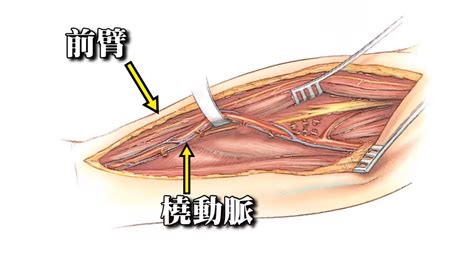 心肌梗塞手術：什麼是冠狀動脈繞道手術｜許原彰醫師