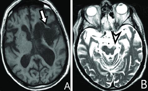 A Axial T1 Wi B T2 Wi Atrophy Of The Left Basal Ganglia Shown By A