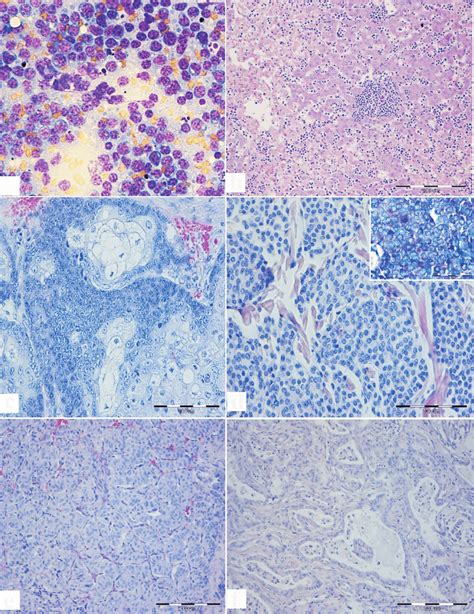 Neoplasms A Aspirate Of An Enlarged Subcutaneous Lymph Node