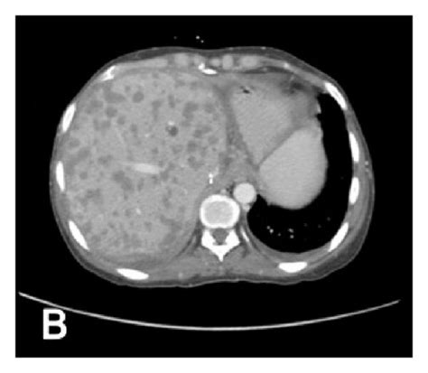 A Abdomen Ct Showing Diffuse Neoplastic Infiltrative Involvement Of
