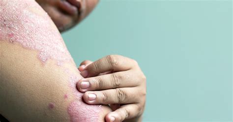 Steroid Free Foam Shows Promise For Scalp And Body Psoriasis Relief