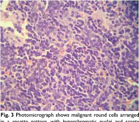 Figure 3 From Peripheral Type Of Primitive Neuroectodermal Tumour