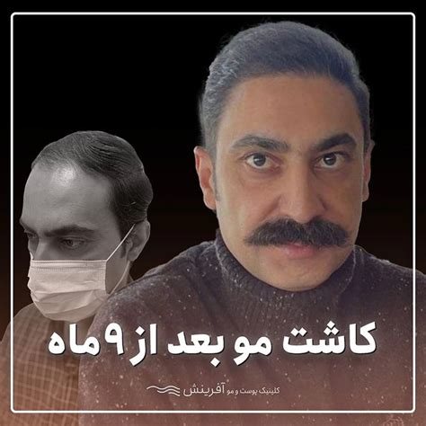 کاشت مو در شیراز بهتر است یا تهران؟ چرا تهران بهتره؟