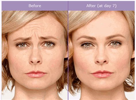 Botox Meirson Dermatology