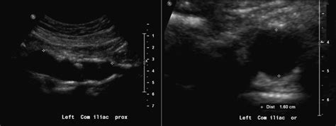 Lower Extremity Arterial Disease Radiology Key