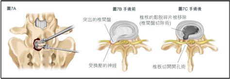 椎間盤突出的6個自測法極速解痛7大方法 Beauty Place