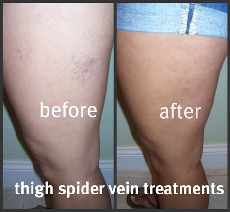 Sclerotherapy Vein Treatment