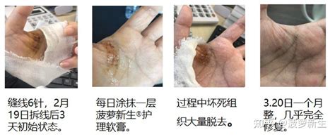 祛疤冷知识您知道多少呢？？ 知乎