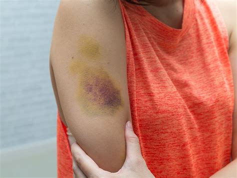 Lump In Arm After Bruise At Brooke Rentoul Blog