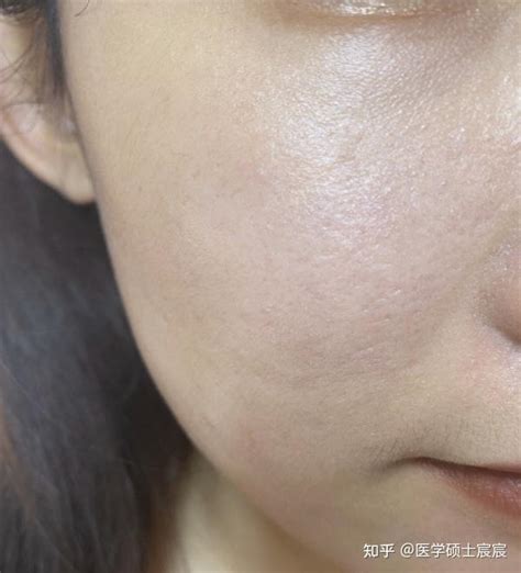 【痘坑必看】痘坑如何恢复？脸上痘坑一直凹凸不平，痘坑真的无解吗？【皮肤科医生】教你3步修复痘坑，2个月还原光滑妈生好皮！！ 知乎