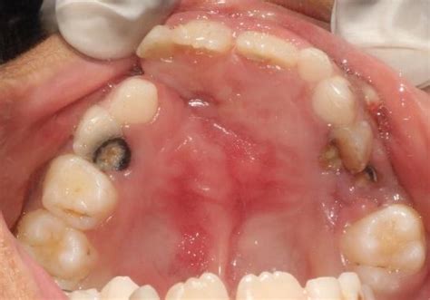 Maxillary Protraction And Preparation For Bone Graft Digital