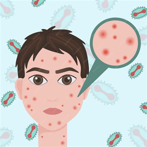 Premium Vector Smallpox Virus Vector Illustration Of Smallpox Virus