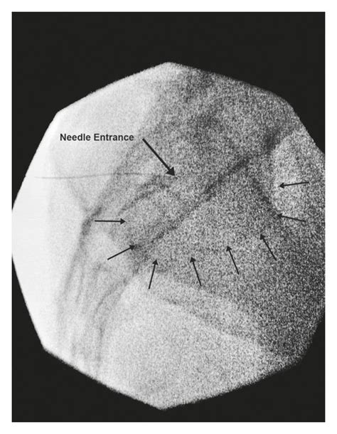 Lateral View Of Fco Needle Placement Large Arrow With Arthrogram