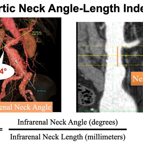 Five Year Overall Survival Rate Between Aortic Neck Angle Length