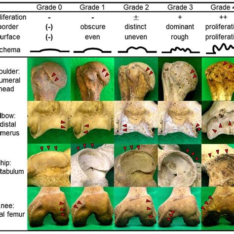 Periarticular Marginal Osteophytes Criteria For Grade 0 1 2 3 And