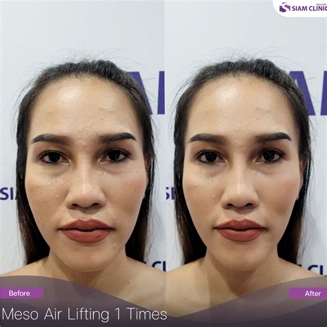 Brightening Treatment Before And After Photos Siam Clinic Thailand