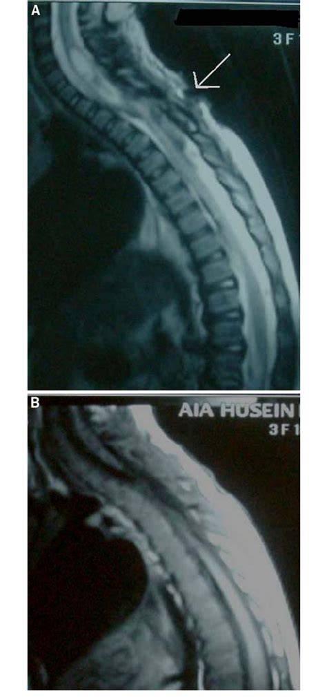 A Gadolinium Enhanced Sagittal Mri T1 W Of The Cervical Spine
