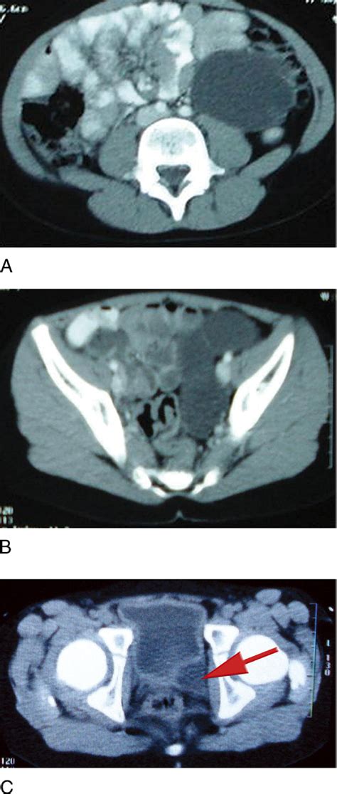 Double Blind Ureteral Duplication A Rare Urologic Anomaly Urology