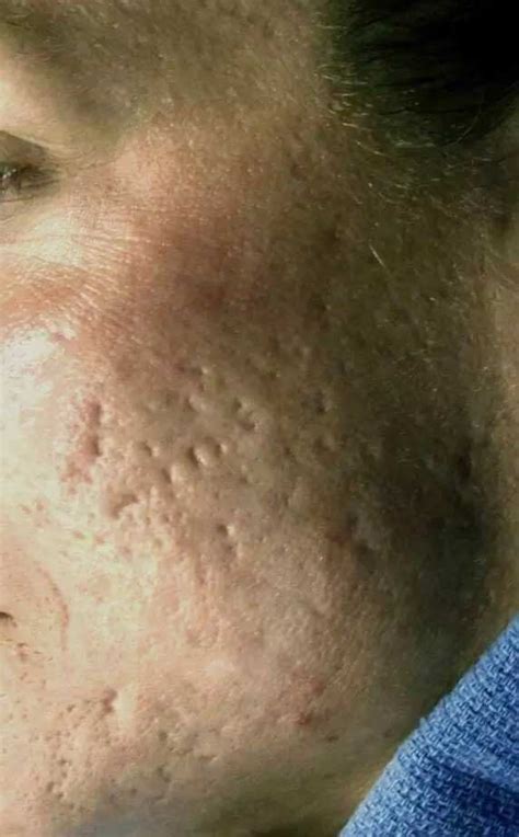 Dermabrasion Cleveland Cosmetic Surgery Procedures