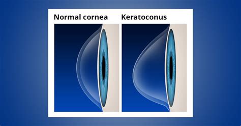 Keratoconus Articles On Symptoms Causes And Treatment