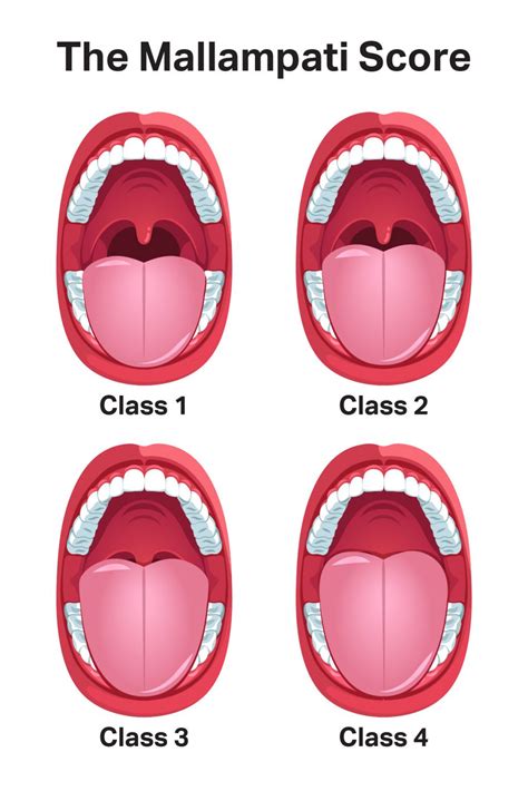 Mallampati Score And Predicting Sleep Apnea Sleep Foundation