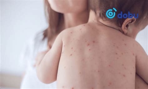 Улаанбурханаар өвдсөн нэг хүүхэд хүнд байна Dobu Mn