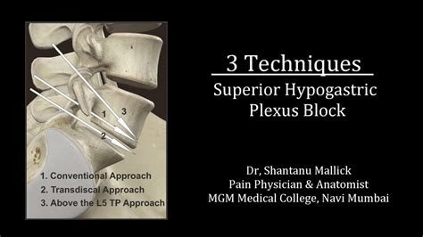 Superior Hypogastric Plexus Block 3 Techniques Youtube