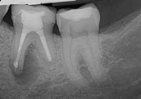 Endodontic Surgery Jensen Endodontics Inc