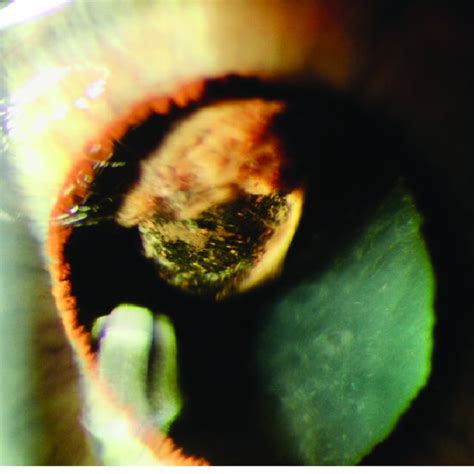 Gonio Photograph Of The Right Eye At Presentation Shows Local Bulging