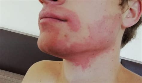 Mans Boredom Left Him With Chemical Burns On His Face Real Fix