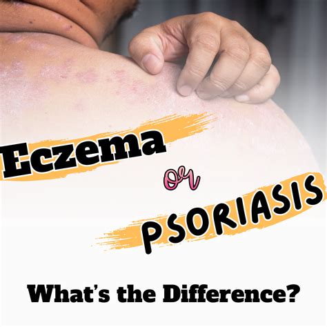 Whats The Difference Between Eczema And Psoriasis P2 And You