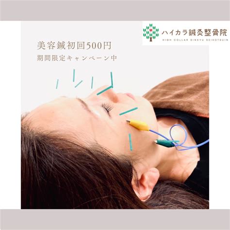 美容鍼初回500円🥰 お得なキャンペーン実施中！｜お知らせ・ブログ｜吹田駅近くのハイカラ鍼灸整骨院
