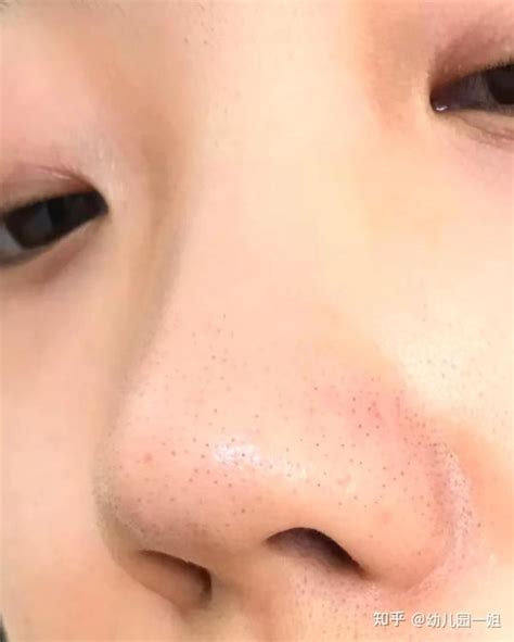 鼻子被黑头占据，毛孔也被撑大了，有没有彻底去黑头收毛孔的方法？ 知乎