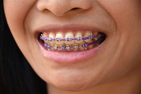 What Are Power Chain Braces How To Take Care Of Them