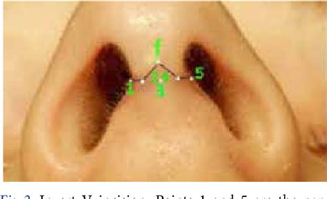 Figure 1 From Evaluation Of Columellar Scar By Three Types Of Incision