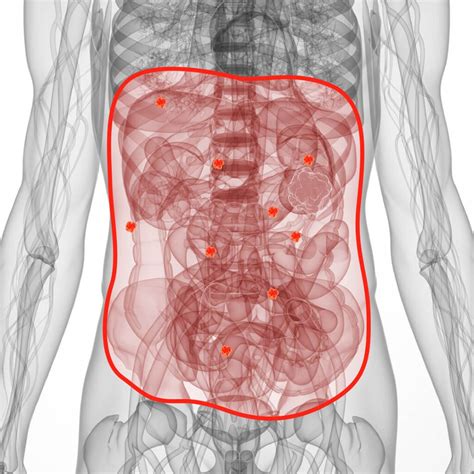 Metastatic Bowel Cancer Treatment