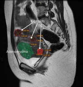 Spotlight On Fibroids Aagl