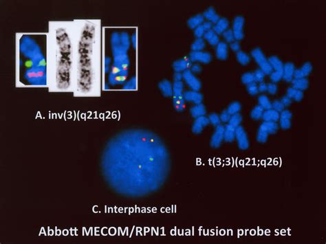 abbott molecular laboratories dual fusion mecom rpn1 abnormal patterns