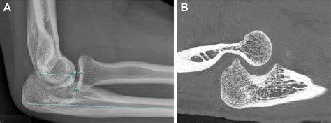 Persistent Elbow Dislocation Jses International