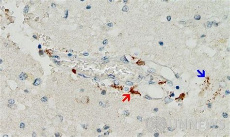 사망한 남성의 뇌와 심장에서 발견된 화이자 Mrna 스파이크 단백질 동료 검토 보고서 Unnews 유엔뉴스 유엔신문