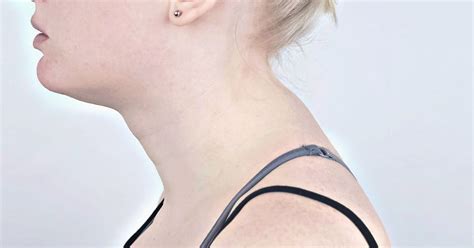 Why Is My Neck Purple At Danica Jones Blog