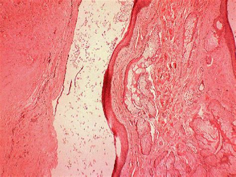 Collision Tumour Dermoid Cyst Right And Mucinous Cyst Left