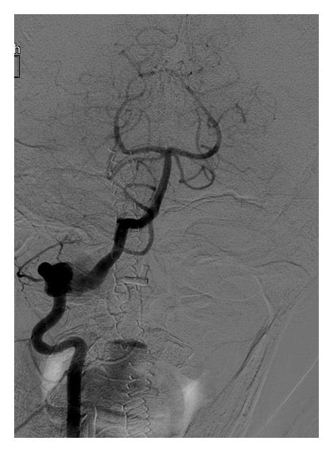 A Shows Normal Filling Of The Right Vertebral Artery Immediately Download Scientific Diagram