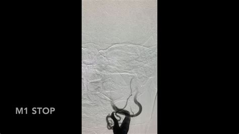 Willem Jan Van Rooij On Linkedin Simple And Quick Thrombectomie Using